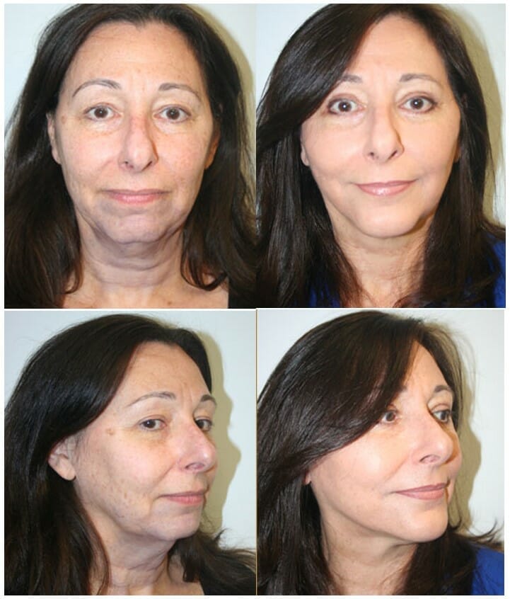 Facial Implant Surgery - Thomassen Plastic Surgery